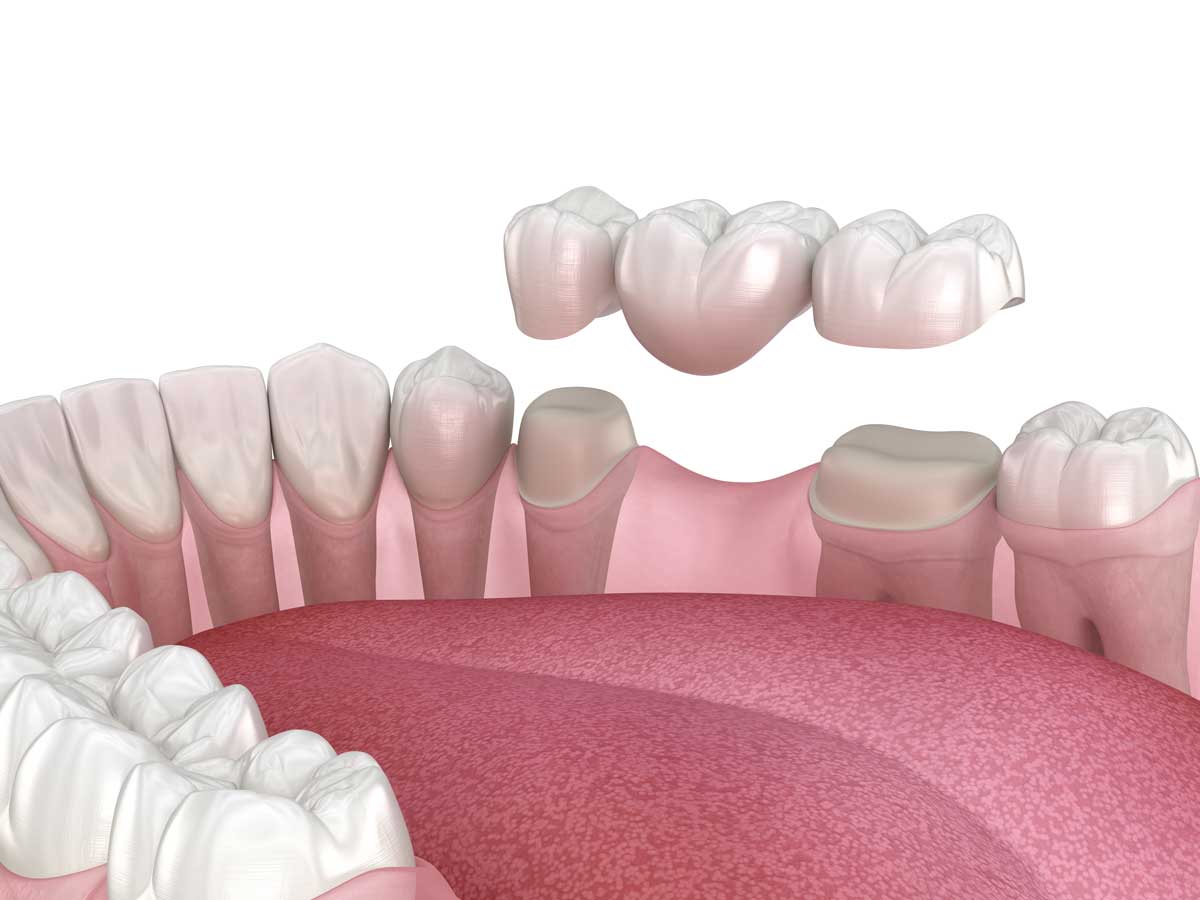 The Difference Between Crowns and Bridges – Heritage Dental